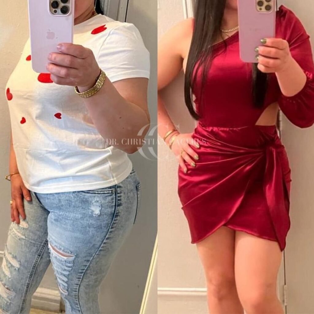 Lipoabdominoplastia – christiancaceres-republicadominicana.com